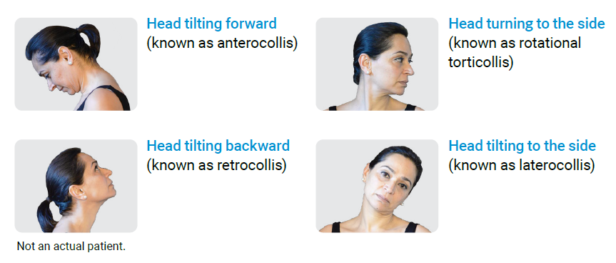 What is Cervical Dystonia? - Dysport® (abobotulinumtoxinA)