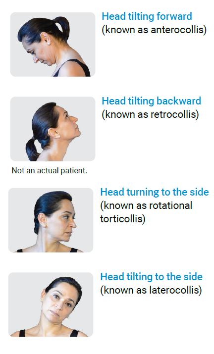What is Cervical Dystonia? - Dysport® (abobotulinumtoxinA)