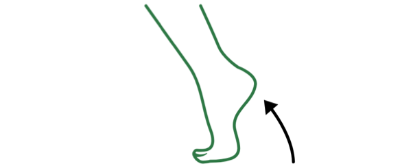 Learn About Pediatric Spasticity - Dysport® (abobotulinumtoxinA)